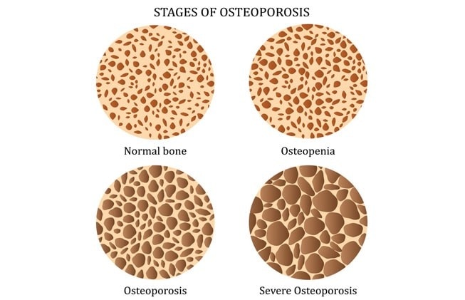 ¿Qué es la osteopenia y cuál es su tratamiento?